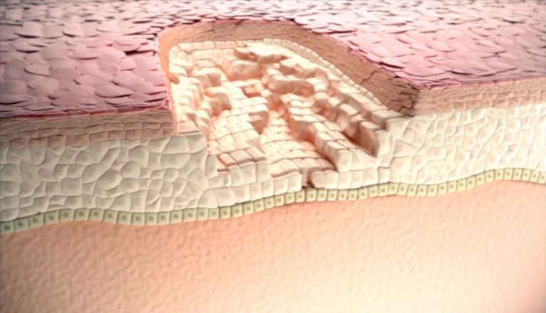 Hyalo4 Plus - fidiawoundcare.com